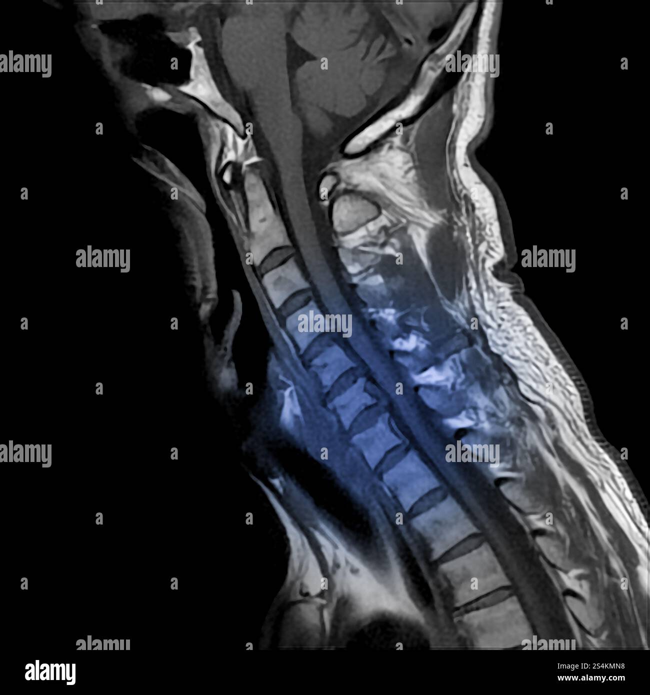 Sagittal view of magnetic resonance image of MRI of cervical spine ...