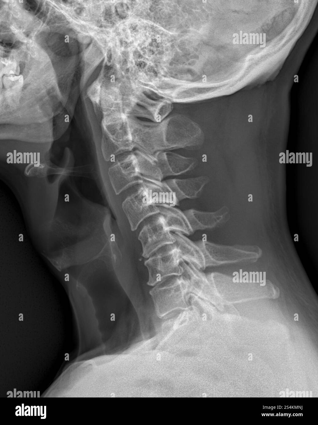 X-ray of the human cervical spine. Early degenerative change at ...