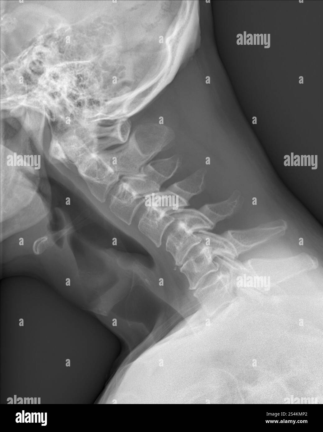 X-ray of the human cervical spine. Early degenerative change at ...