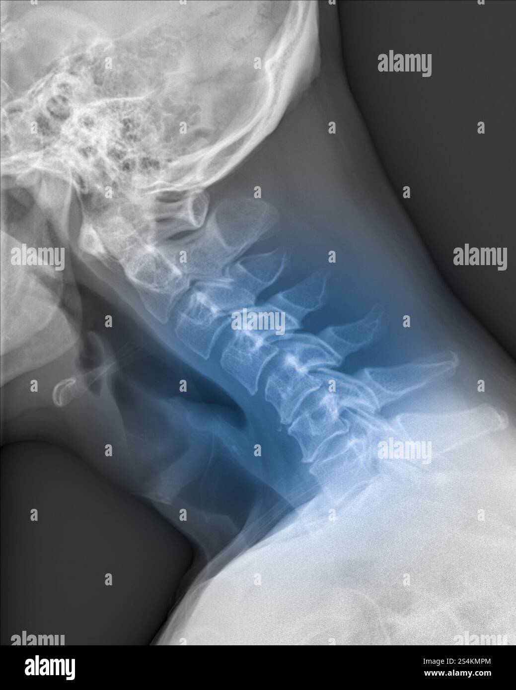 X-ray of the human cervical spine. Early degenerative change at ...