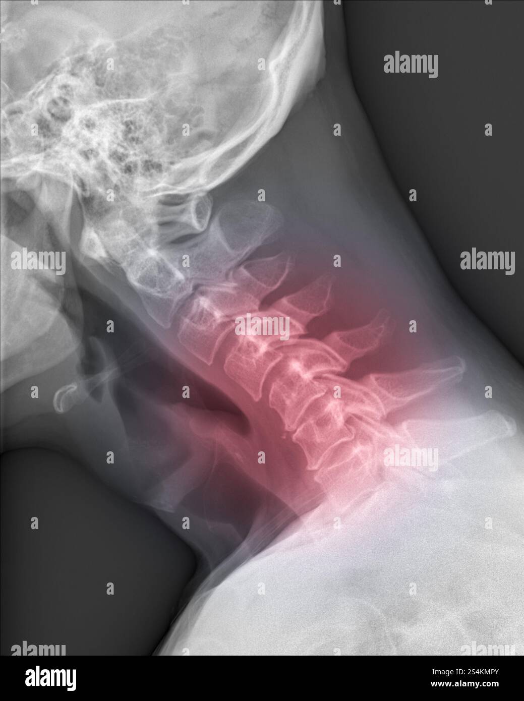 X-ray of the human cervical spine. Early degenerative change at ...