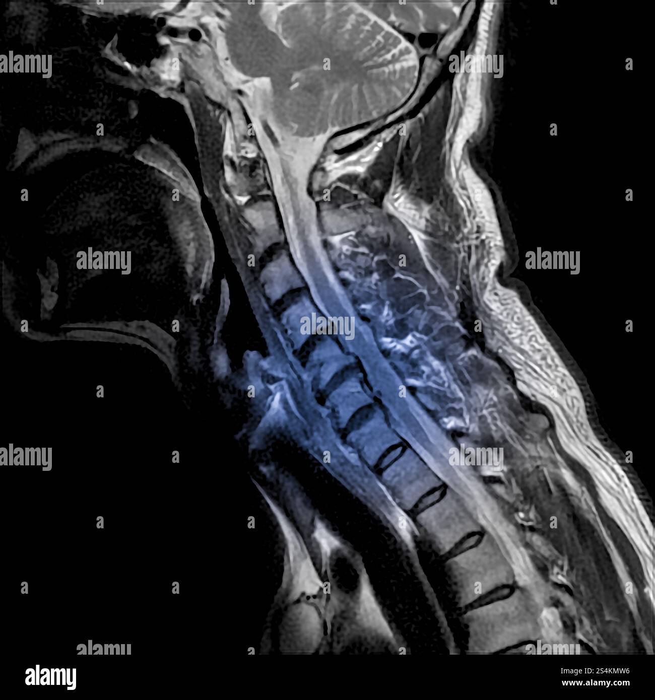 Sagittal view of magnetic resonance image of MRI of cervical spine ...