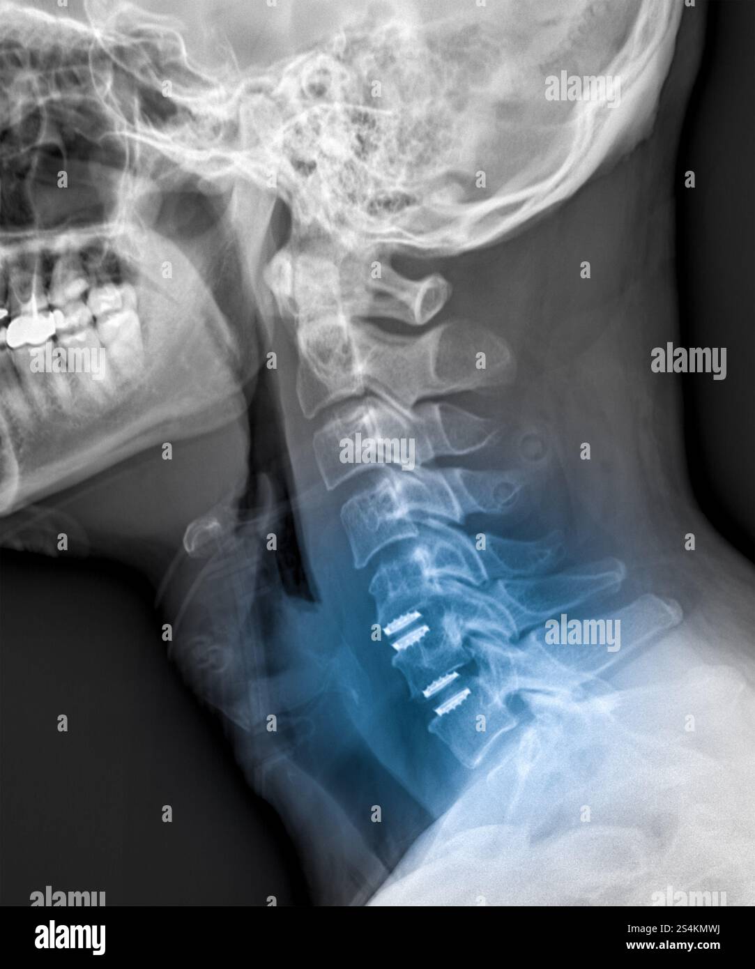 projection x-ray of cervical spine showing Anterior Cervical Discectomy ...