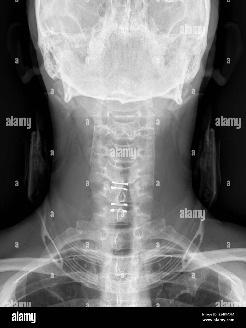projection x-ray of cervical spine showing Anterior Cervical Discectomy ...