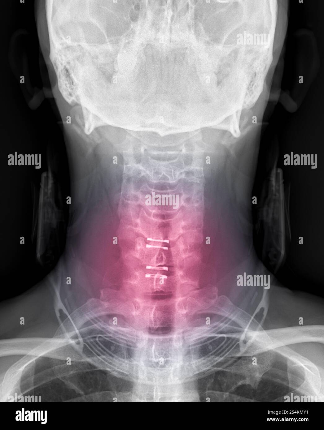 projection x-ray of cervical spine showing Anterior Cervical Discectomy ...