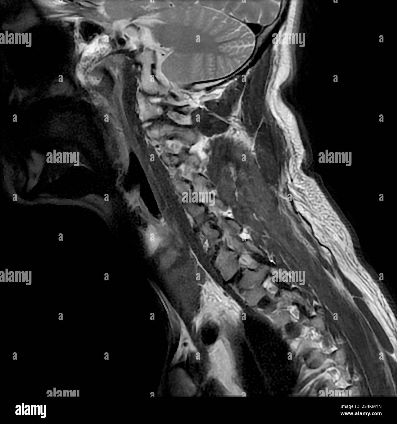 Sagittal view of magnetic resonance image of MRI of cervical spine ...