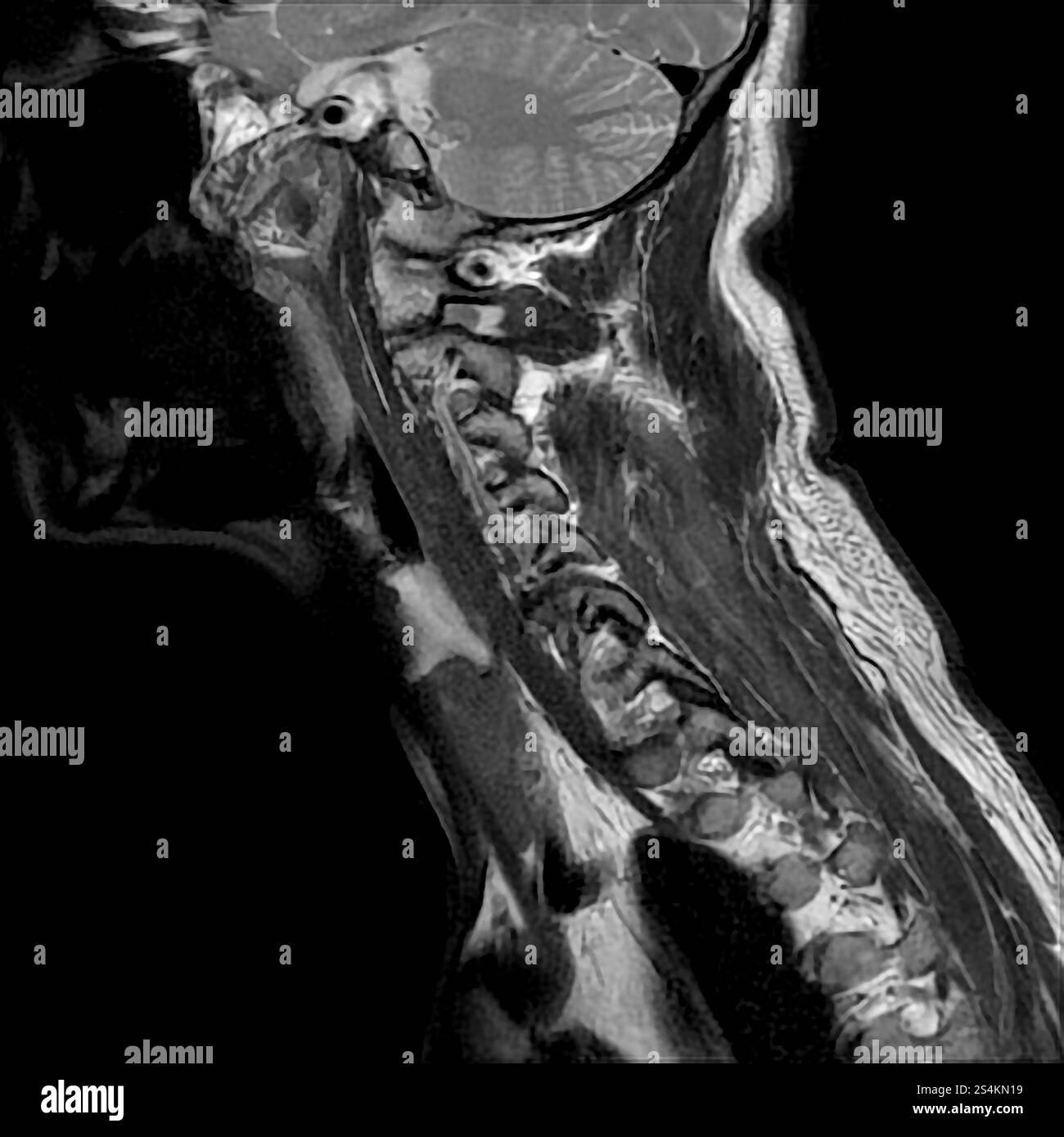 Sagittal view of magnetic resonance image of MRI of cervical spine ...