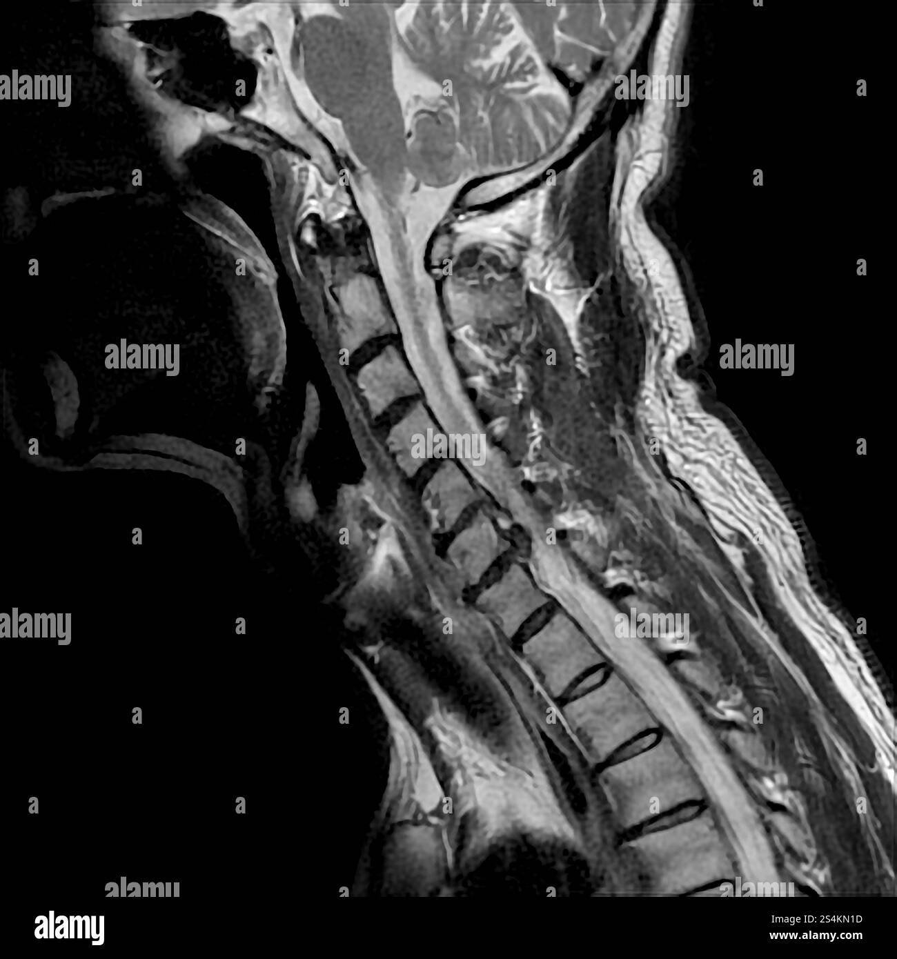 Sagittal view of magnetic resonance image of MRI of cervical spine showing cervical spondylotic ...