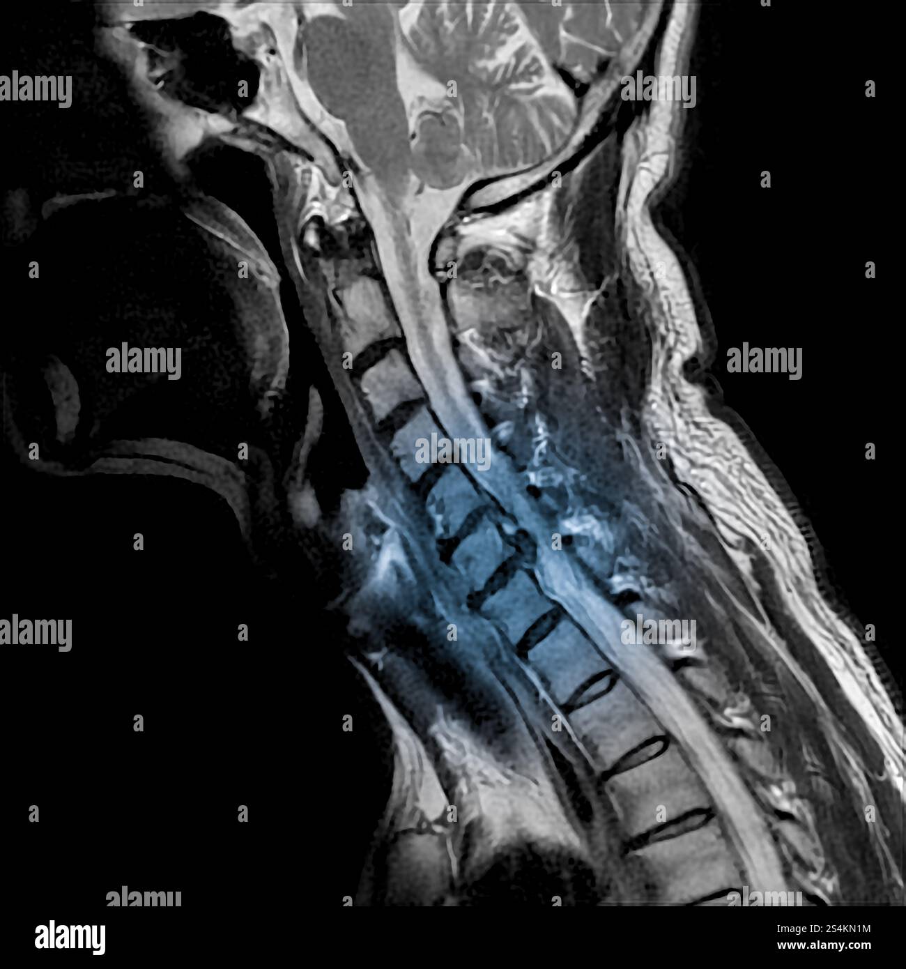 Sagittal view of magnetic resonance image of MRI of cervical spine ...