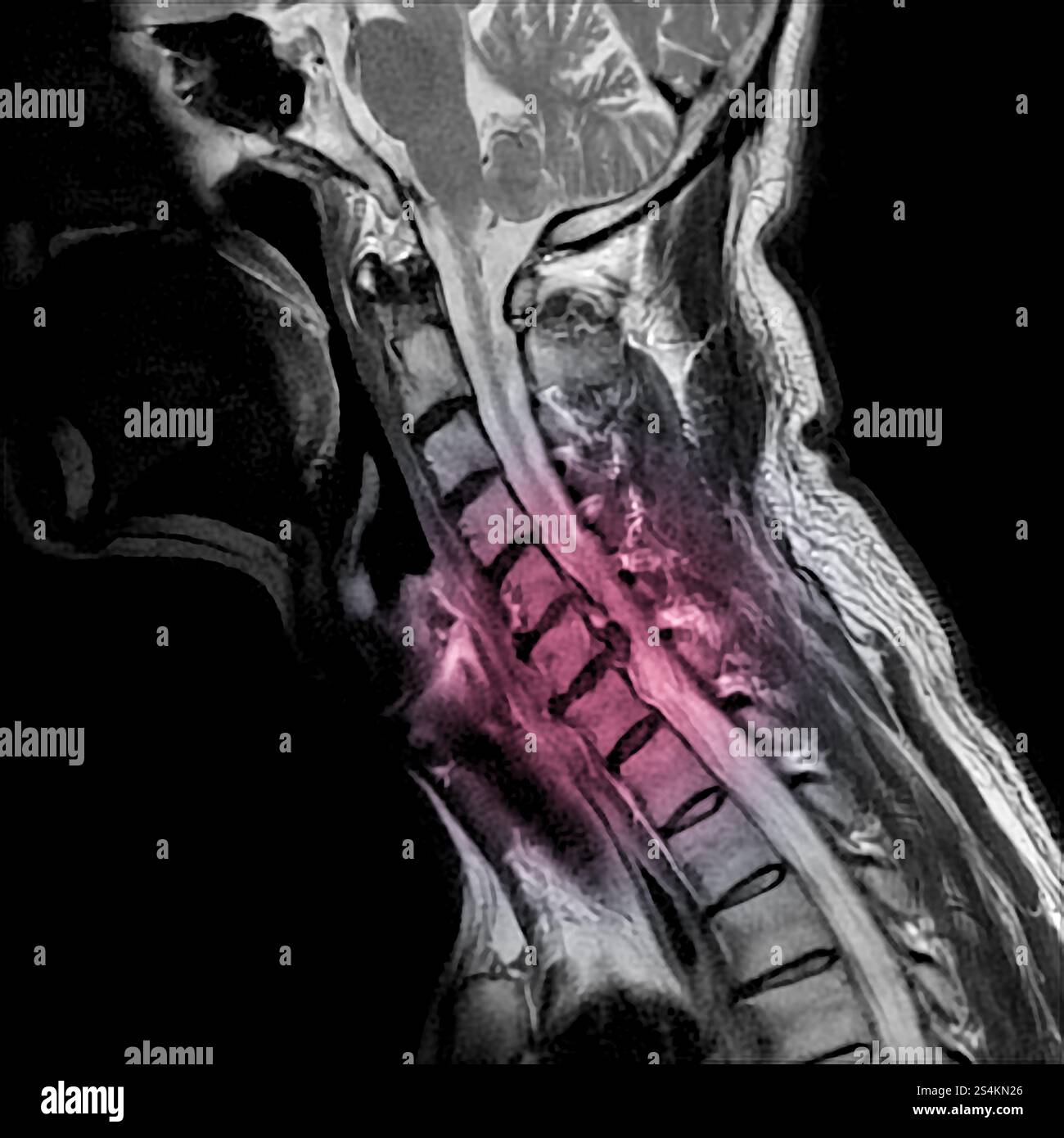 Sagittal view of magnetic resonance image of MRI of cervical spine ...