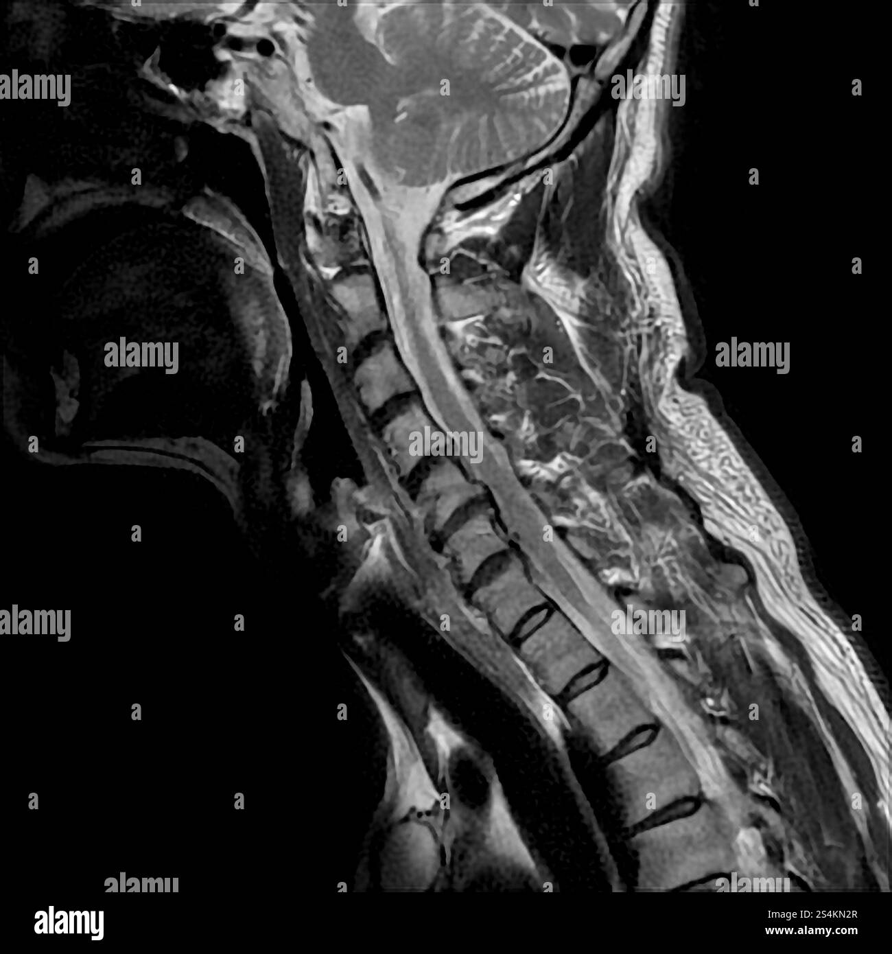 Sagittal view of magnetic resonance image of MRI of cervical spine ...
