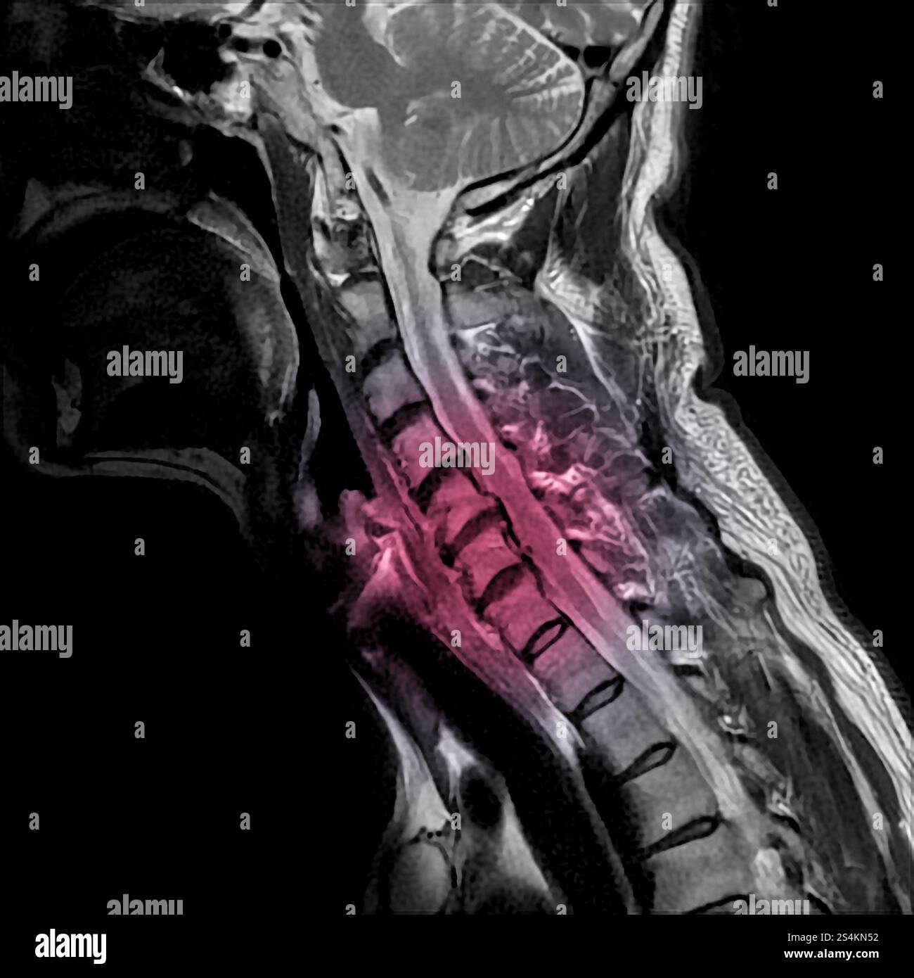 Sagittal view of magnetic resonance image of MRI of cervical spine ...