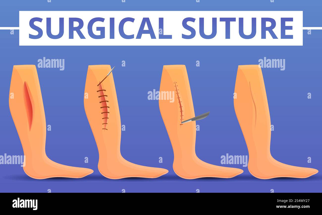 Medical suture concept background. Cartoon illustration of medical ...