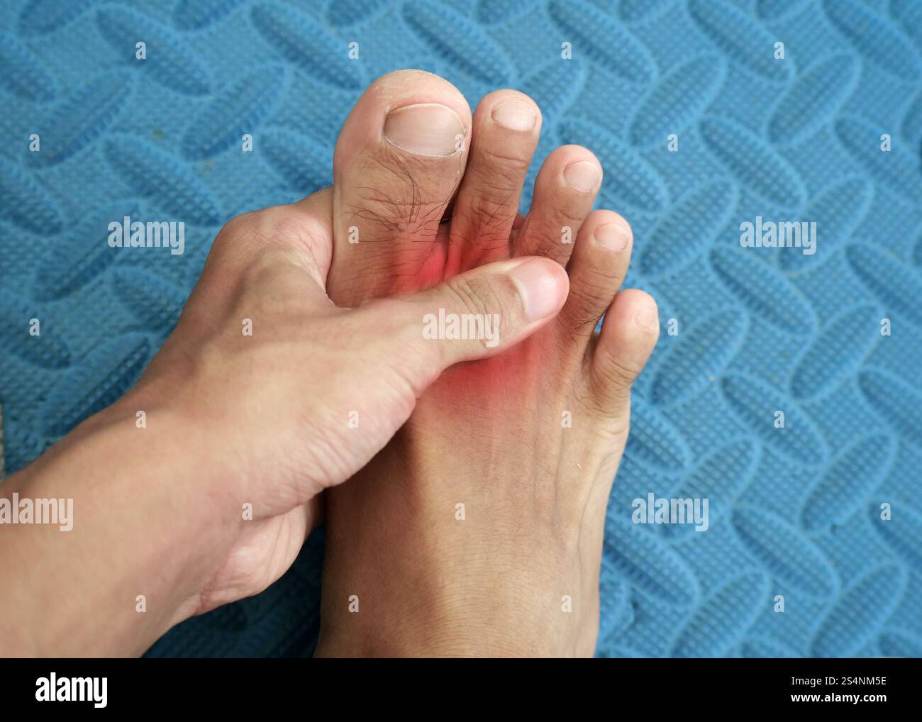 The toes of a man suffering from gout, the painful area highlighted in ...