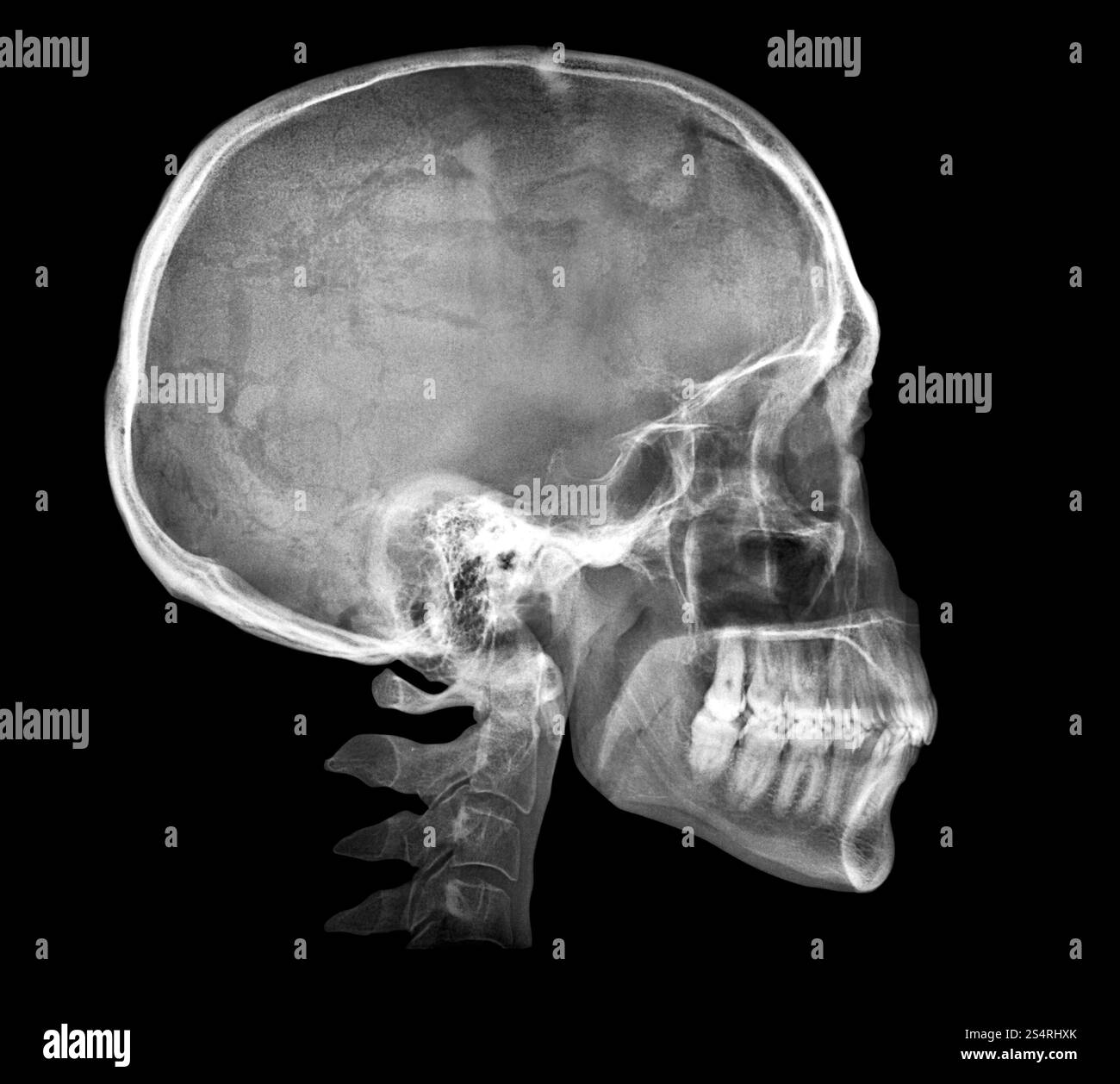 Human skull X-ray image isolated on black. Human skull X-ray image ...