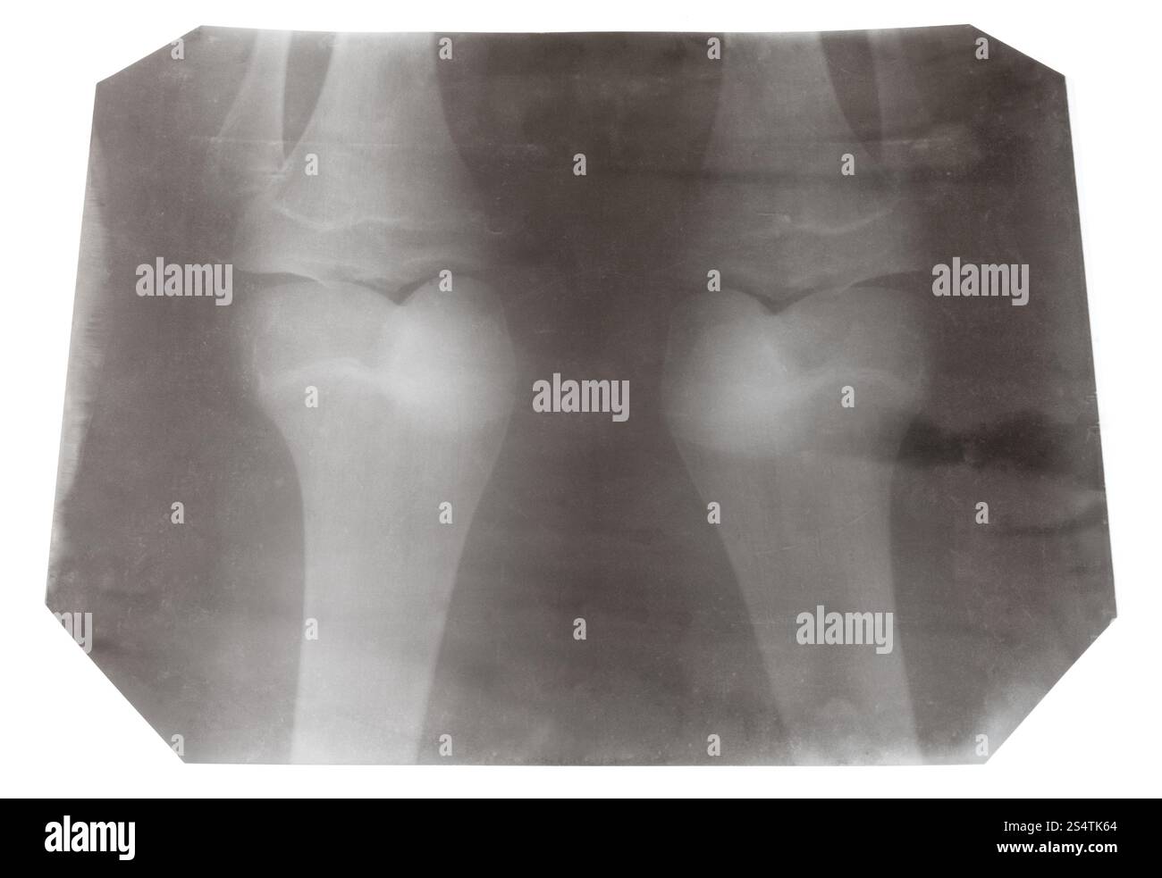 X-ray picture of two human knee-joints isolated on white background ...