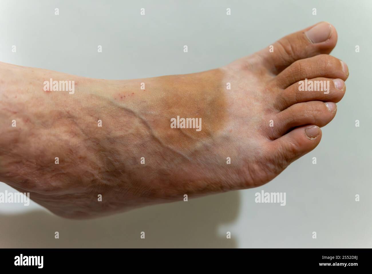 Swollen foot with discoloration due to possible health condition Stock ...