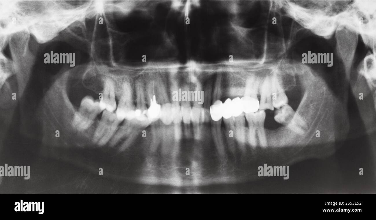 front view of human jaws with dental crown and pins in teeth on X-ray ...