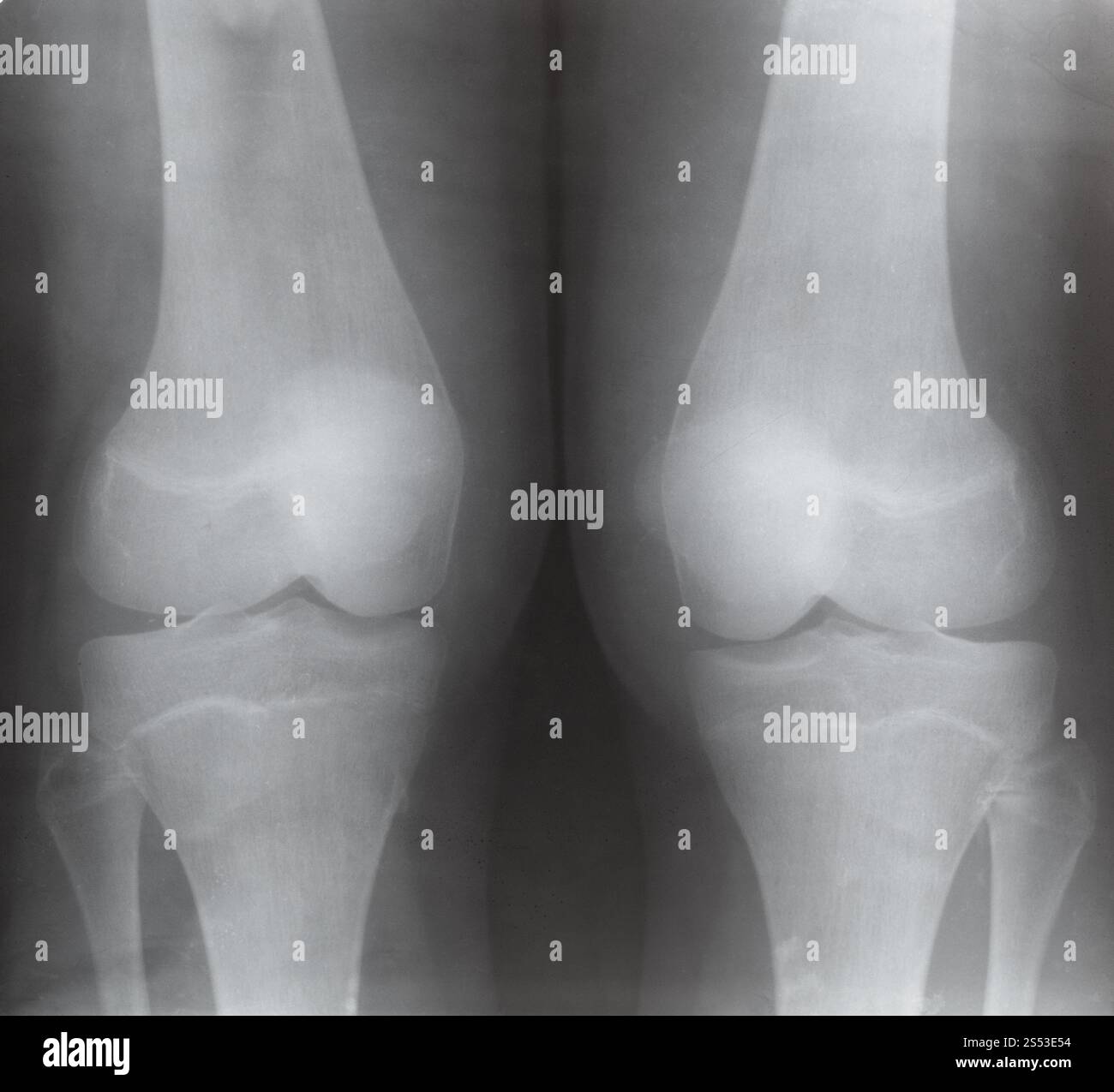 front view of two human knee joints on X-ray image Stock Photo - Alamy