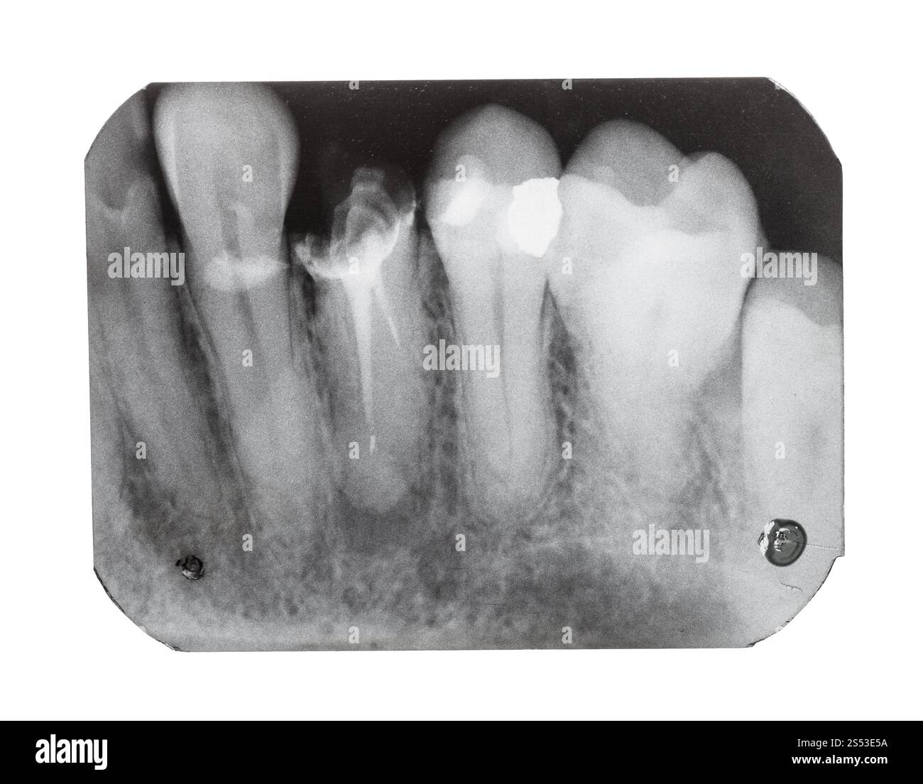 film with X-ray image of human teeth with dental pin close up isolated on white background Stock ...