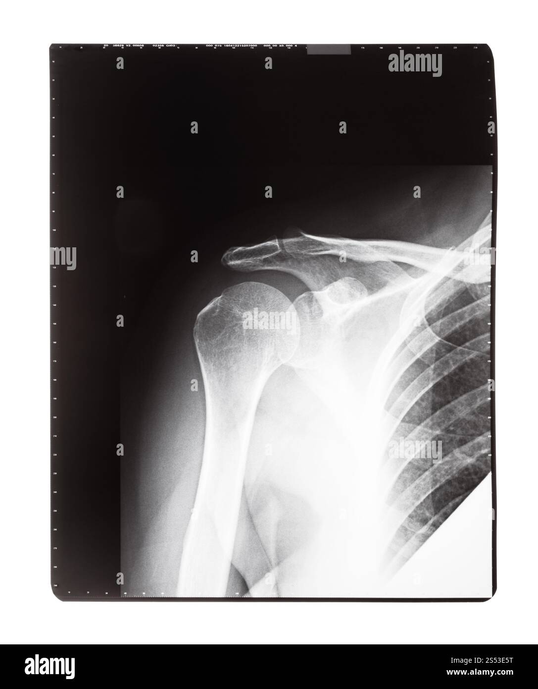 film with X-ray image of front view of human shoulder joint isolated on ...