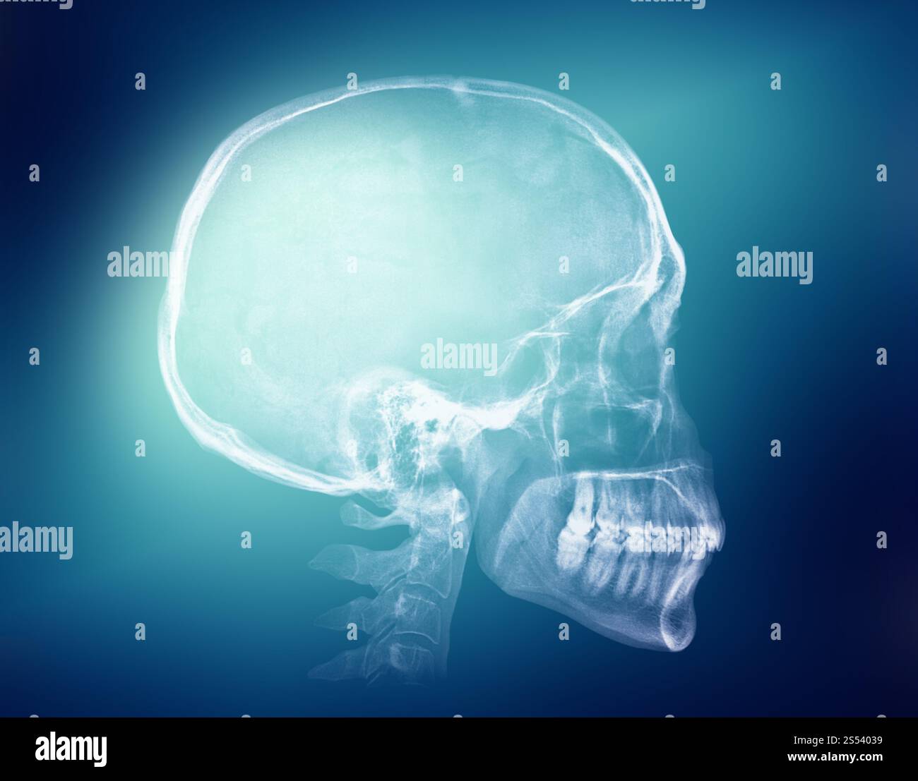 Human skull X-ray image on a blue background. Human skull X-ray image ...