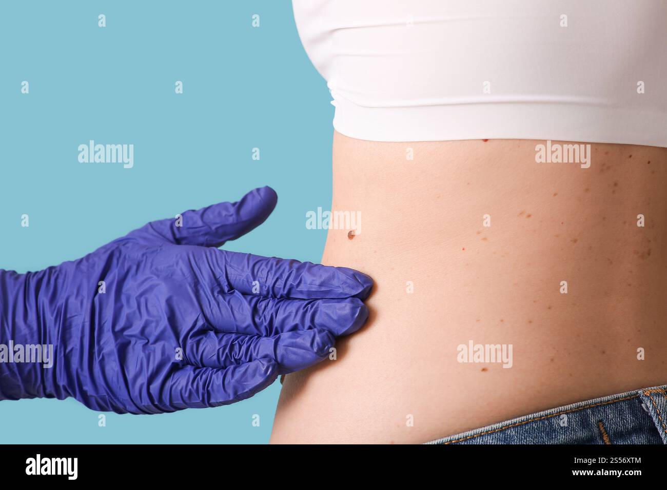 Dermatologist examining moles on woman's belly against blue background ...