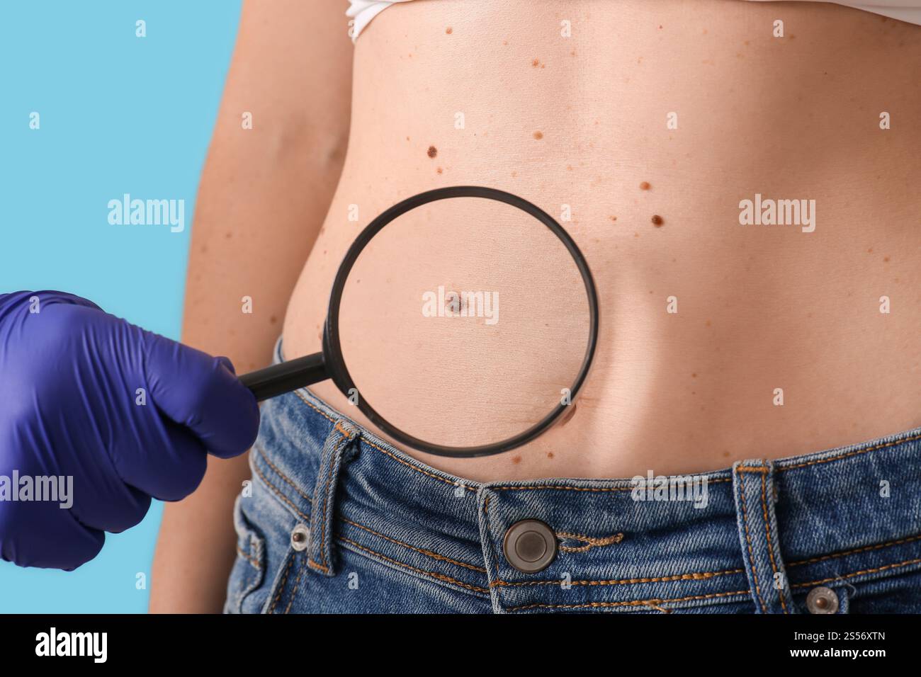 Dermatologist with magnifier examining moles on woman's belly against ...