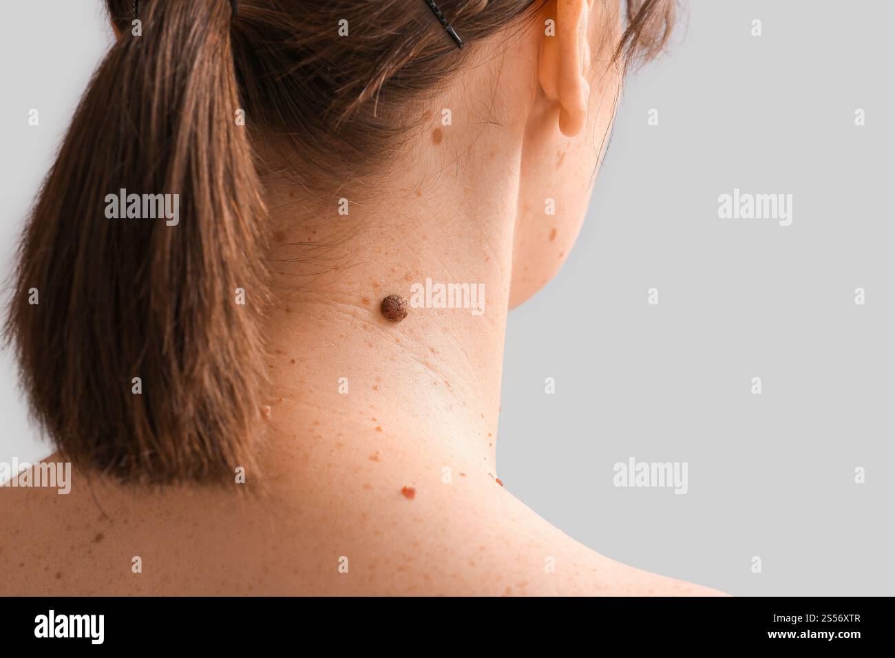 Woman with moles on her neck against light background, back view Stock ...