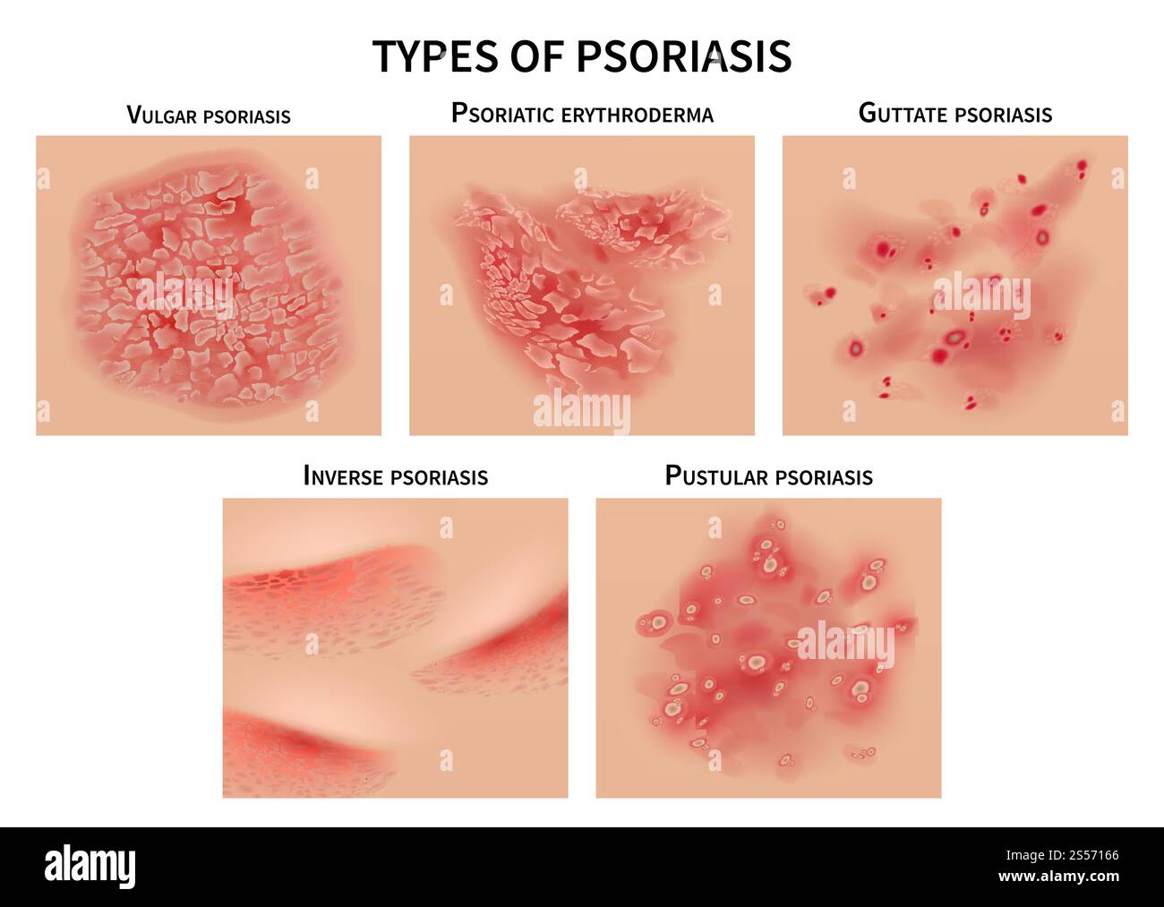 Psoriasis types. Skin hives, derma diseases. Closeup medical vector ...