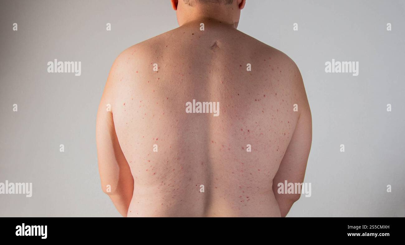 Red pimples on a man's back. Skin irritation and allergy concept ...