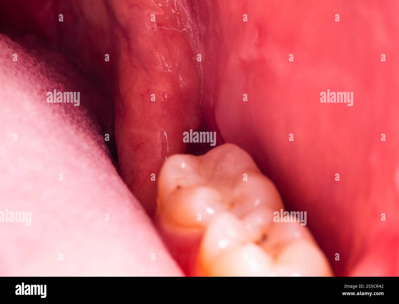 recess after complex impacted wisdom tooth extraction, traumatic ...