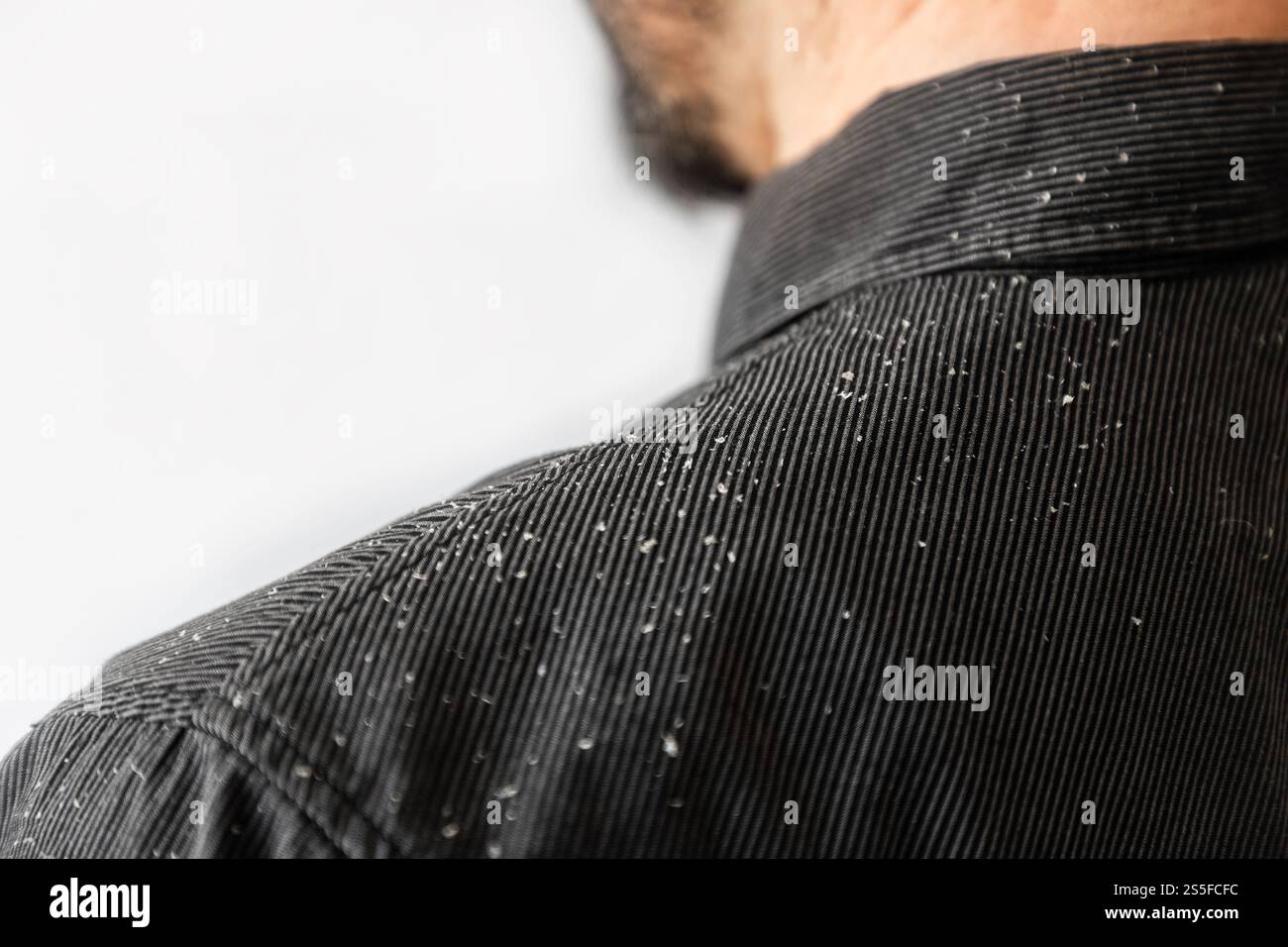 Seborrheic dermatitis in beard hi-res stock photography and images - Alamy
