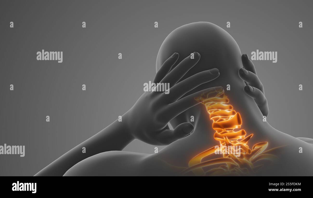Cervical Syndrome Leading to Chronic Neck Discomfort Stock Photo - Alamy