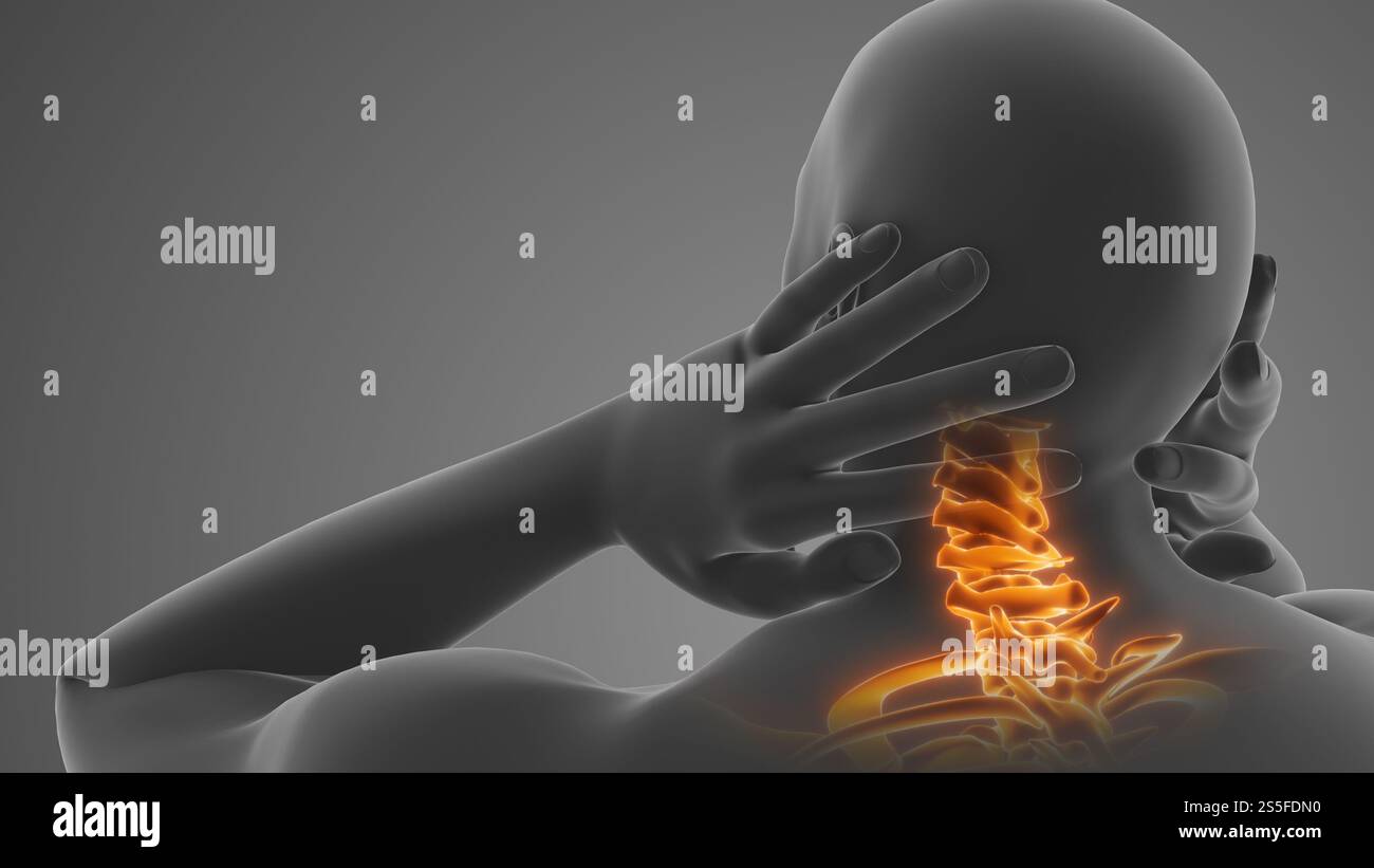 Cervical Syndrome Leading to Chronic Neck Discomfort Stock Photo - Alamy