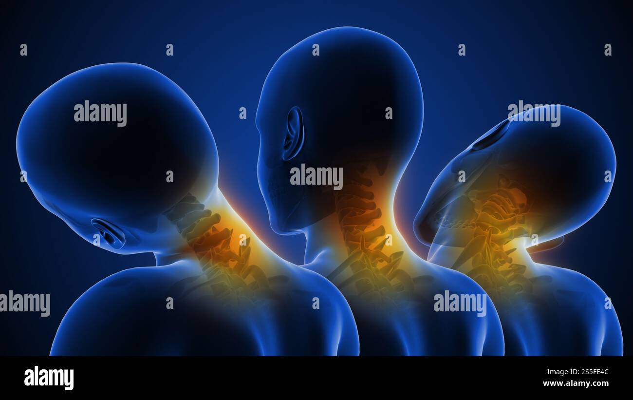 Chronic Neck Pain Caused by Poor Posture Stock Photo - Alamy