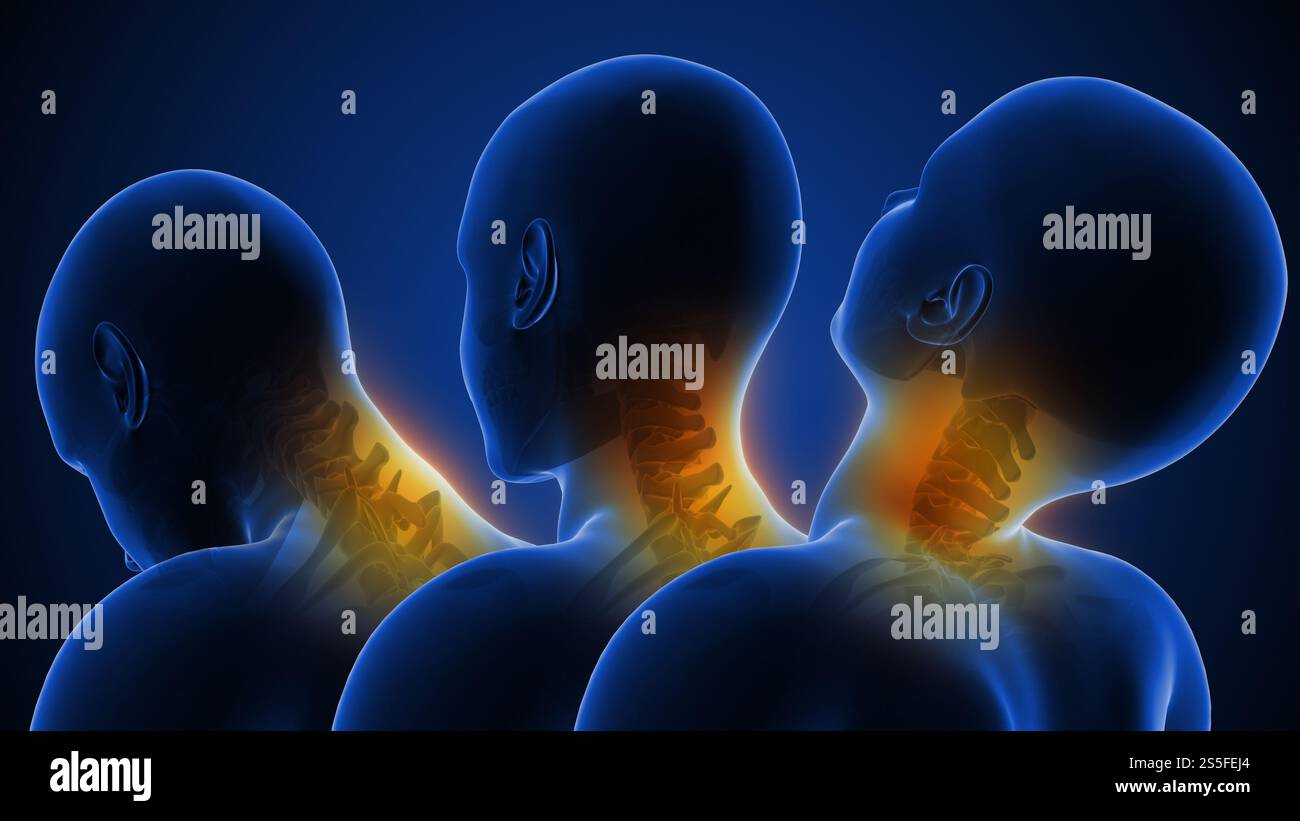 Chronic Neck Pain Caused by Poor Posture Stock Photo - Alamy