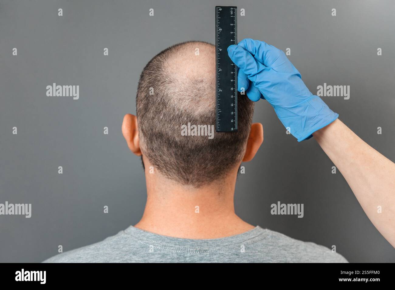 A man with baldness on his head is examined by a trichologist. The ...