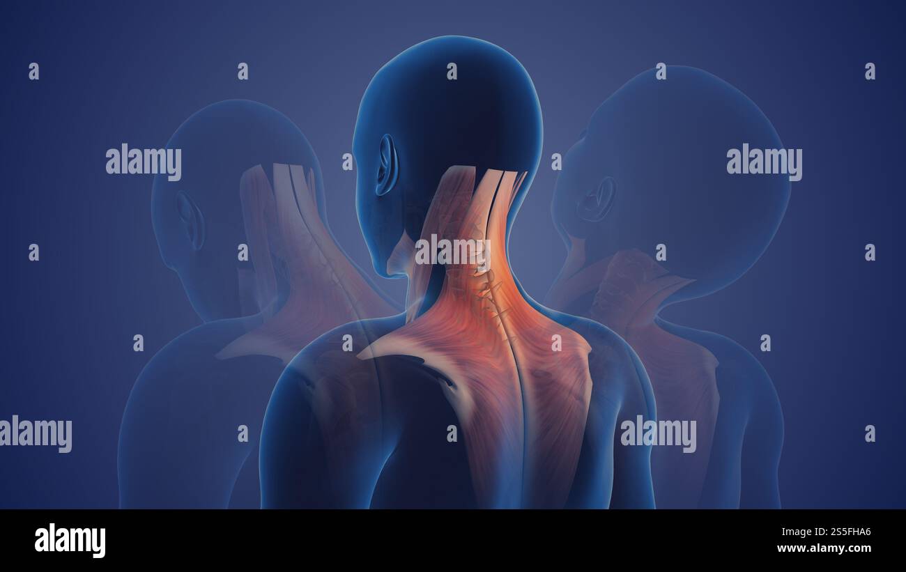 Neck Pain Associated with Cervical Posture Issues Stock Photo - Alamy