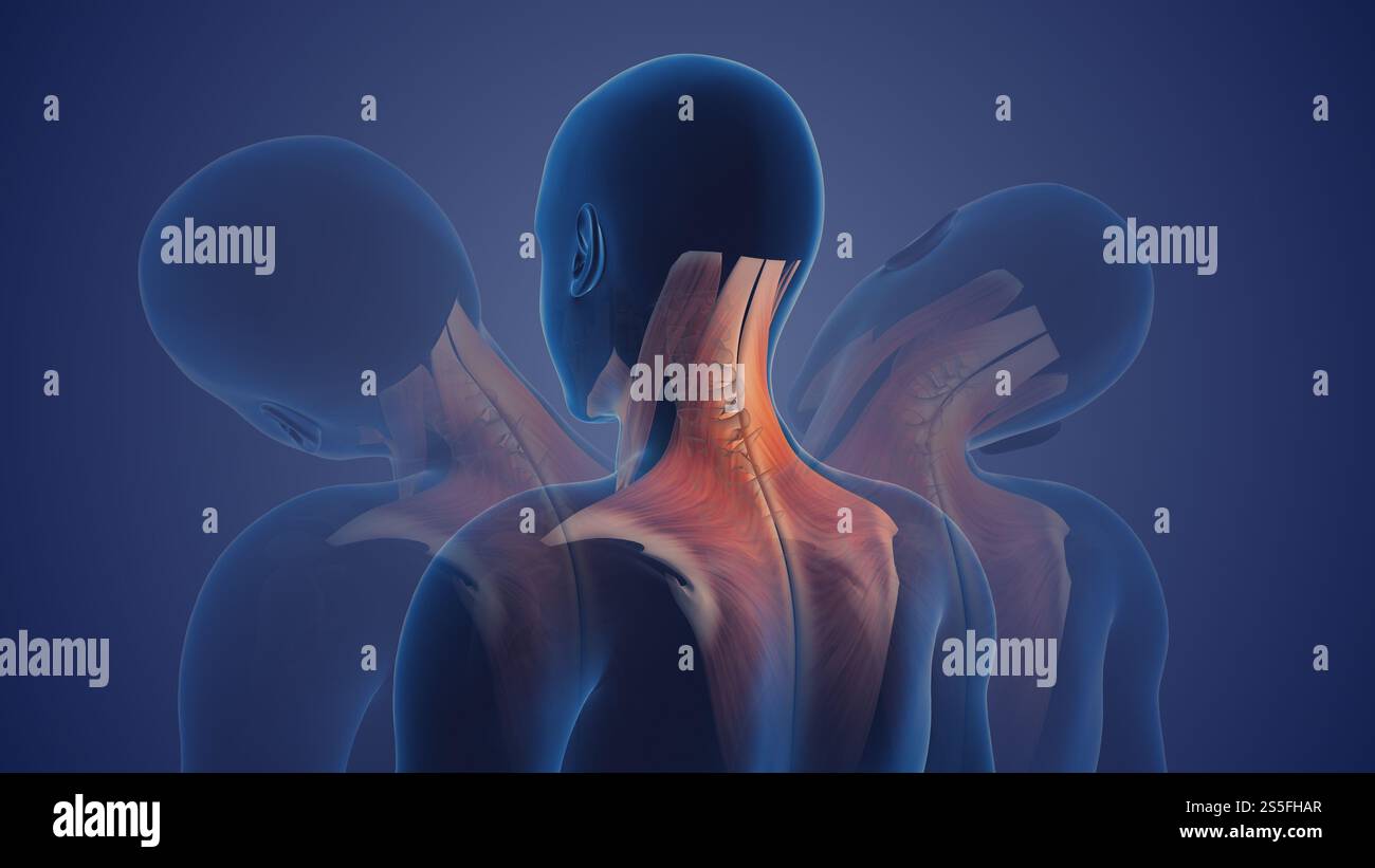 Neck Pain Associated with Cervical Posture Issues Stock Photo - Alamy