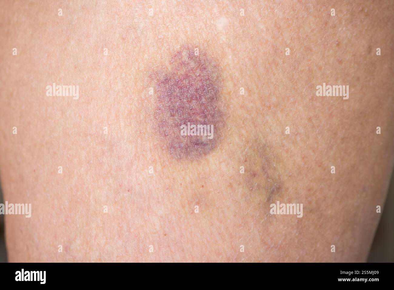 Close-up of woman with bruised skin on her body. Bruise on upper leg ...