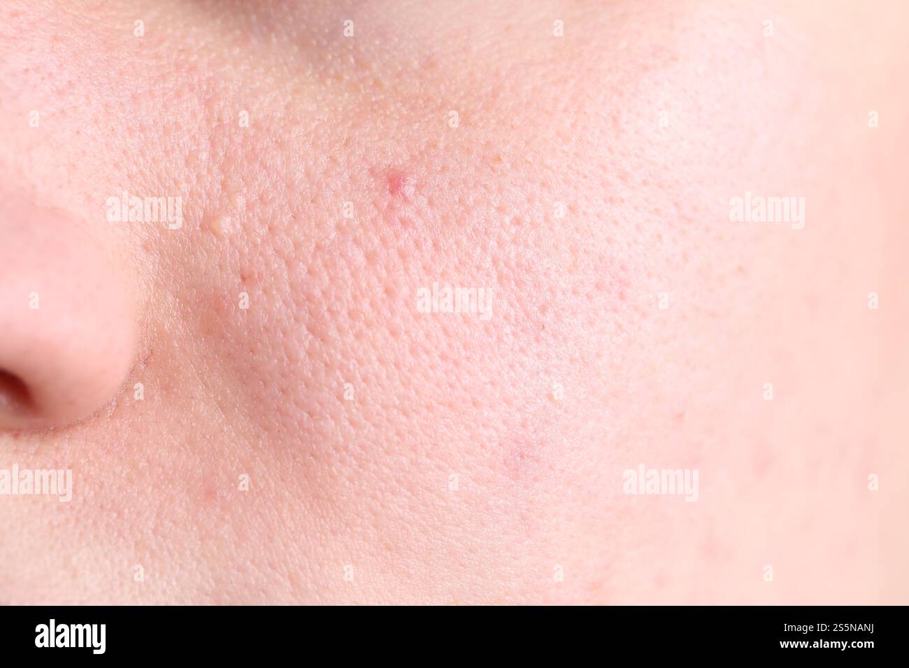 Texture of skin with enlarged pores as background, closeup Stock Photo ...