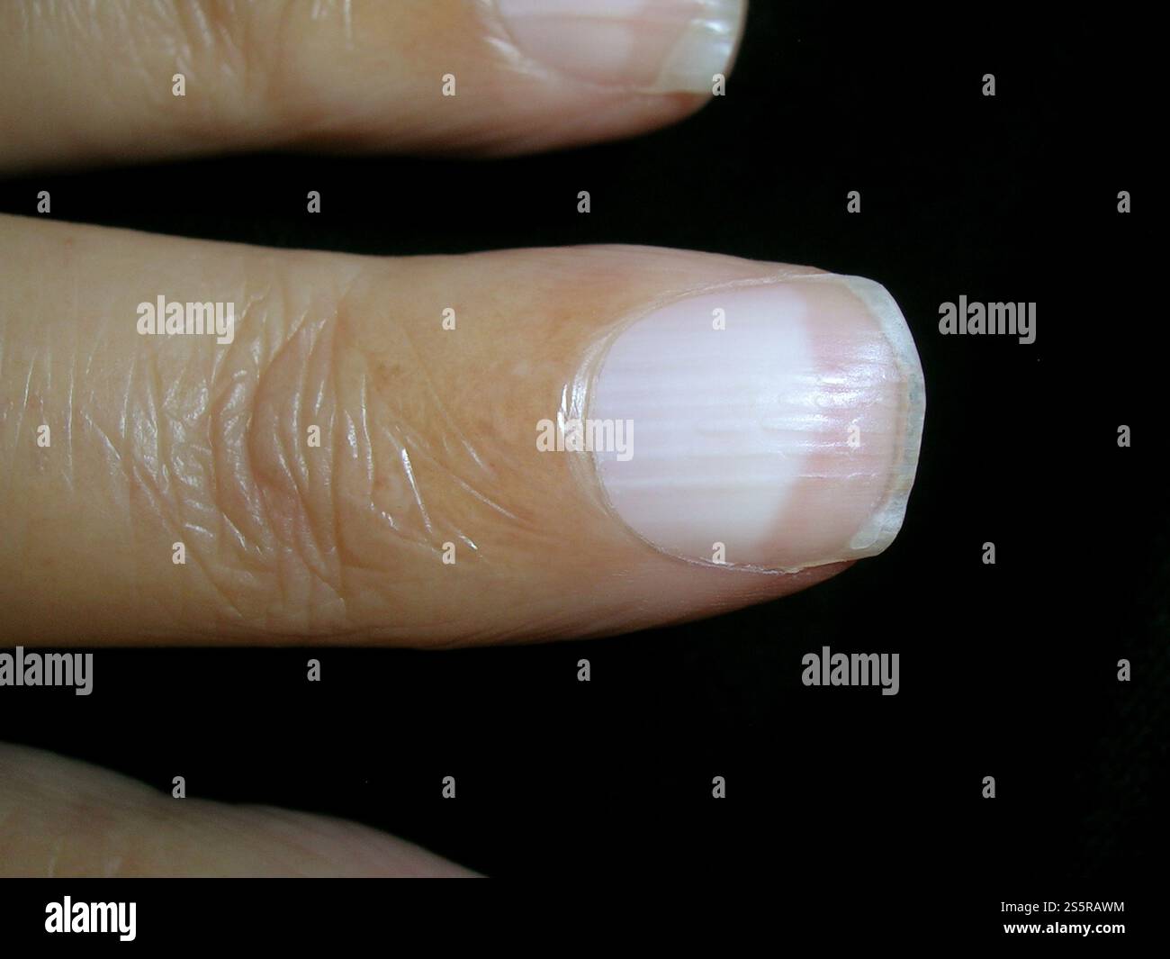 Finger of a 50 year old white male patient with Terry's nails, a type ...