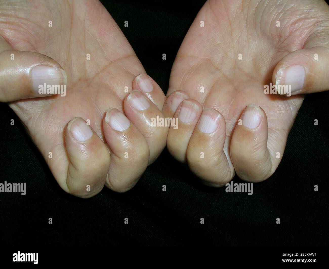 Hands of a 50 year old white male patient with Terry's nails, a type of ...