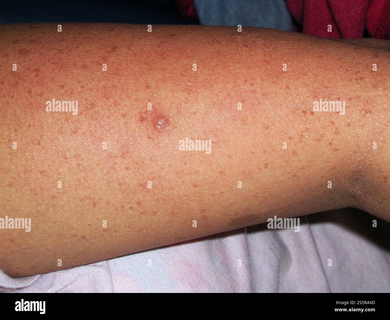 Recklinghausen's disease. Freckles and nodule on the arm of a 22 year ...