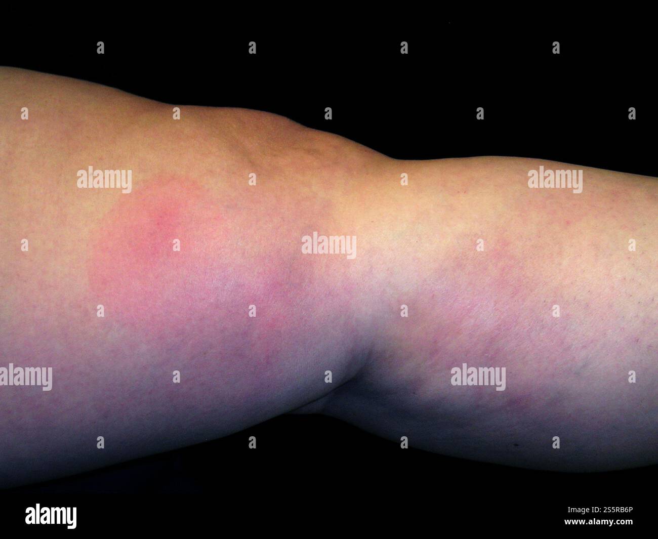 Red lesions on the leg of a patient with erythema nodosum. This ...
