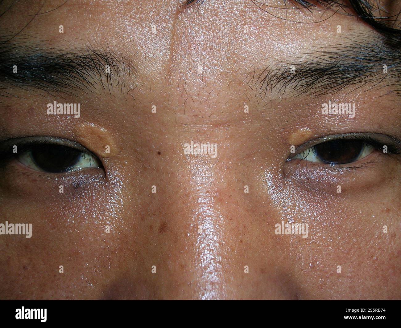 Xanthelasma deposits around a the eyes of a 28 year old Asian man. This ...