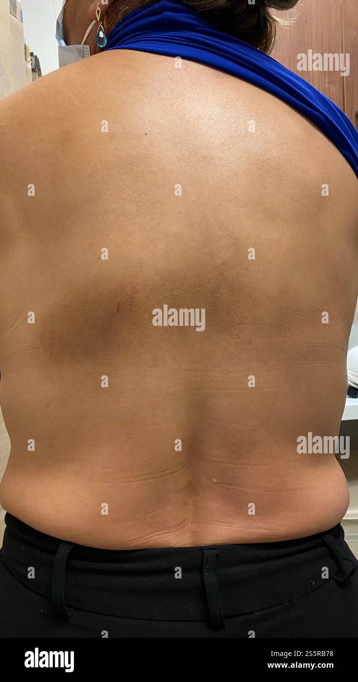 Notalgia paresthetica. This is a disorder of the nerves in the upper ...