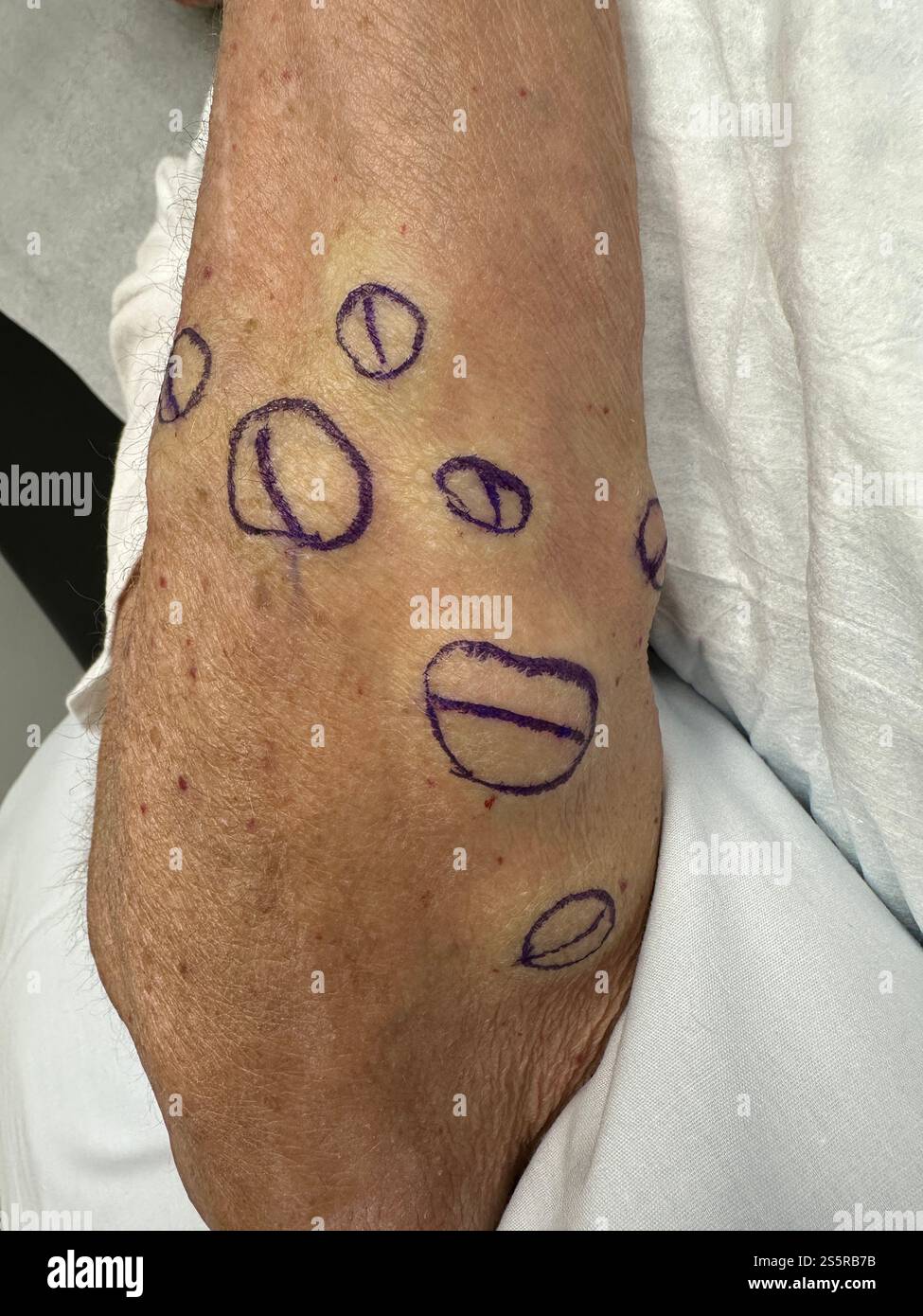 Lipomas marked for excision on the arm of a 66 year old Hispanic male ...