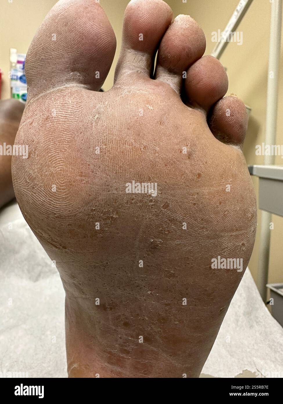 Foot of an African-American patient with erythrasma (between the toes ...